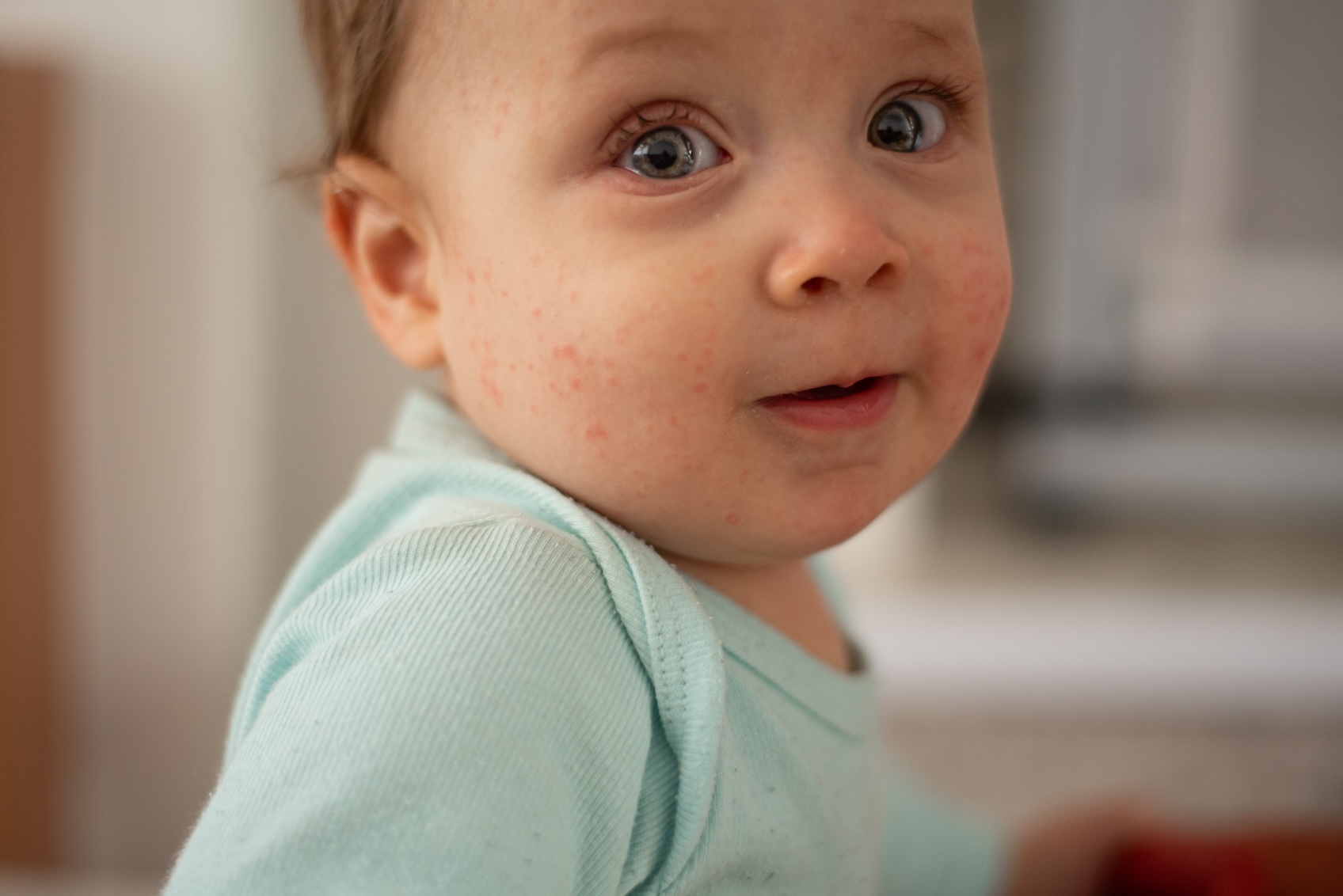 Vauvarokko nostaa korkean kuumeen – miten pitkään ikävät oireet kestävät?